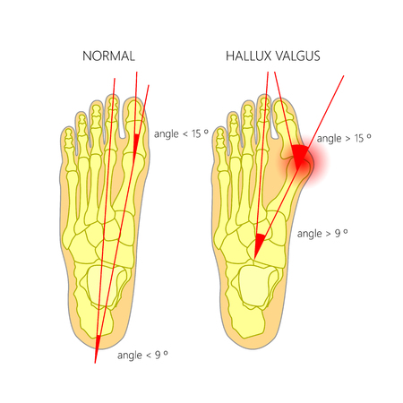 Illustration of the normal foot and hallux valgus with indicating of ...