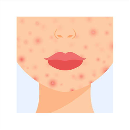 Vector of Problem Skin on Female Face. - ID:1-189038750 - Royalty Free ...