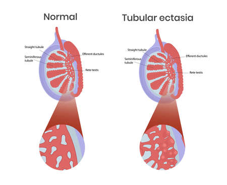 Photo of Tubular ectasia of rete testis - ID:151393070 - Royalty Free ...