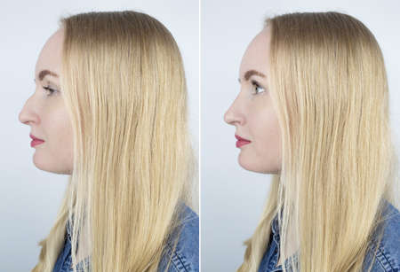 Photo of Before and after rhinoplasty. - ID:1-187209565 - Royalty Free ...