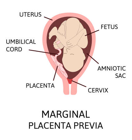 Vector of Different Placental Locations - ID:142185340 - Royalty Free ...