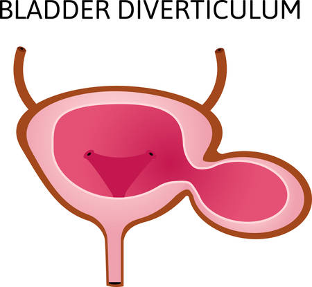 Vector of A bladder diverticulum is a - ID:1-144265711 - Royalty Free ...