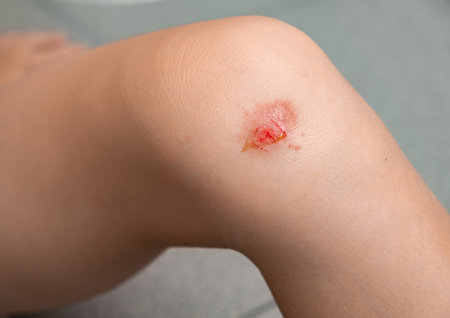 Wounded knee of the child. Abrasion on the lap of boy close-up after ...