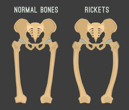 Vector of Normal bones versus Rickets - ID:1-96252042 - Royalty Free ...