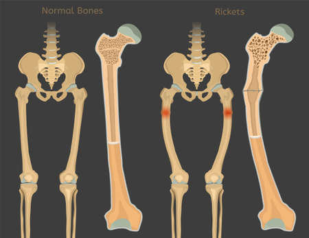 Vector of Normal bones versus Rickets - ID:1-96764684 - Royalty Free ...