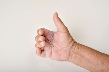 Photo of Hand surgery treatment, - ID:1-185072731 - Royalty Free Image ...