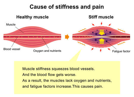 Vector of Cause of muscle's stiffness - ID:1-123849247 - Royalty Free ...
