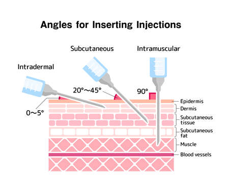 Angles for Inserting Injections vector illustration:: موقع تصميمي