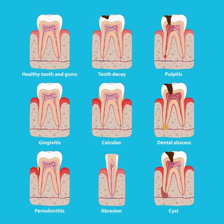Vector of Popular teeth diseases icons - ID:1-124970618 - Royalty Free ...