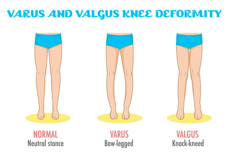 Valgus/varus knee, legs disease/deformation infographic. Shows normal ...
