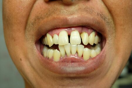 Yellow teeth Images - Search Images on Everypixel
