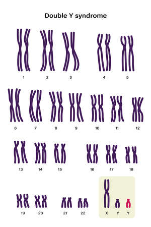 Xyy Syndrome Diagram
