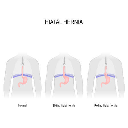 Vector of Hiatal hernia. Vector diagram - ID:1-126954141 - Royalty Free ...