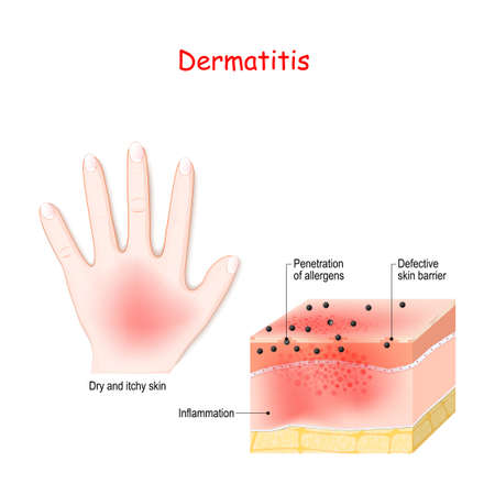 Vector of Dermatitis. Atopic eczema. - ID:1-131700522 - Royalty Free ...