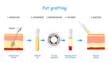 Vector of Fat grafting steps: from - ID:1-166578243 - Royalty Free ...