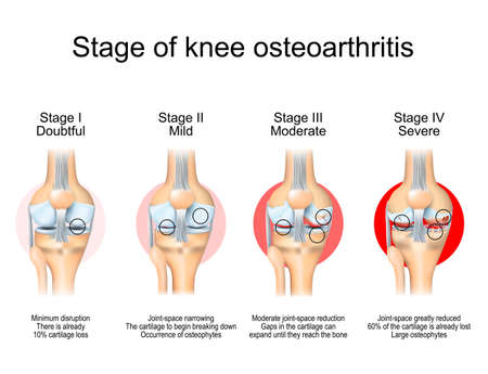 Vector of Stages of knee osteoarthritis. - ID:1-187338237 - Royalty ...