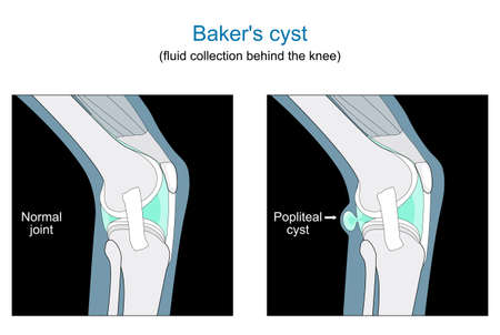 Vector of Baker's cyst. fluid collection - ID:188051274 - Royalty Free ...