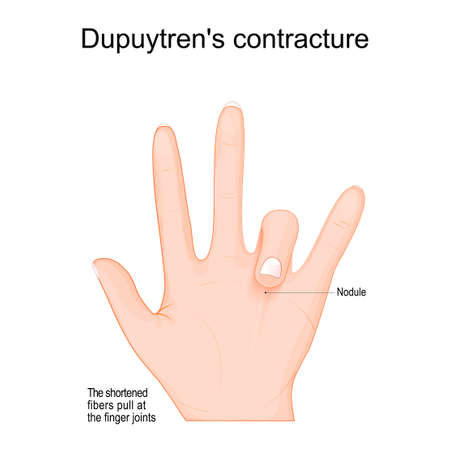 Vector of Dupuytren's contracture finger - ID:1-189443259 - Royalty ...