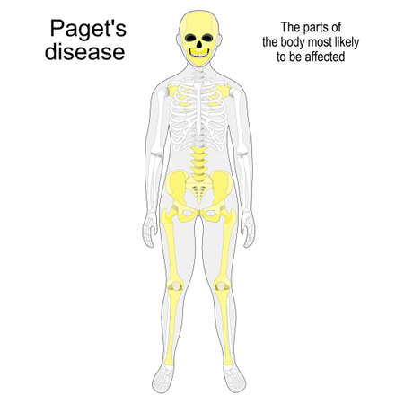 Vector of paget's disease of bone. - ID:1-189979084 - Royalty Free ...