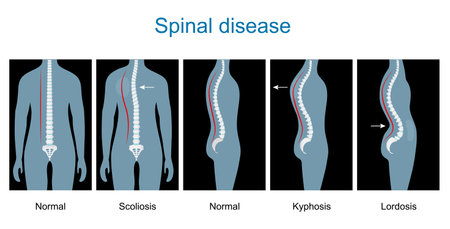 Vector of spinal disease. types of spine - ID:1-194026748 - Royalty ...