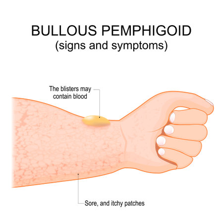 Vector of Bullous pemphigoid. autoimmune - ID:1-194026746 - Royalty ...