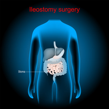 Vector of ileostomy. stoma. surgical - ID:1-195365395 - Royalty Free ...