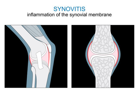 Vector of Types of Synovitis. - ID:1-195365406 - Royalty Free Image ...