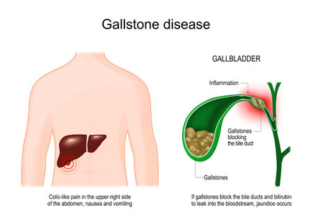 Vector of gallstone disease. human body - ID:1-197700245 - Royalty Free ...