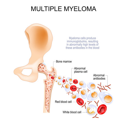 Vector of multiple myeloma. Myeloma - ID:197723331 - Royalty Free Image ...