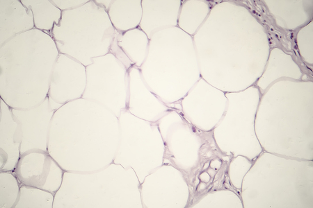 Photo of Lipoma, benign growth of fatty - ID:1-106551557 - Royalty Free ...