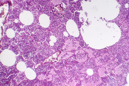 Lobar pneumonia, hemorrhagic edema period, light micrograph, photo ...