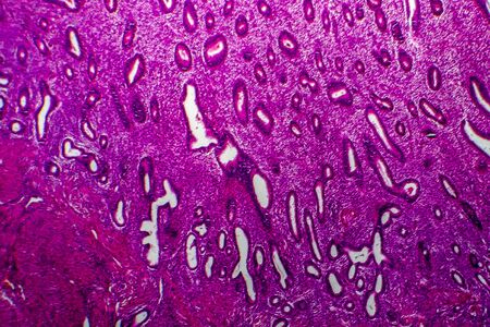 Photo of Endometrial hyperplasia, light - ID:1-142232099 - Royalty Free ...