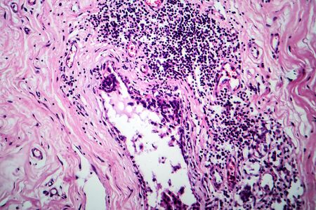 Breast fibroadenosis, light micrograph, photo under microscope. Common ...