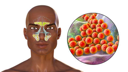 Photo of Staphylococcus aureus bacteria - ID:171140152 - Royalty Free ...