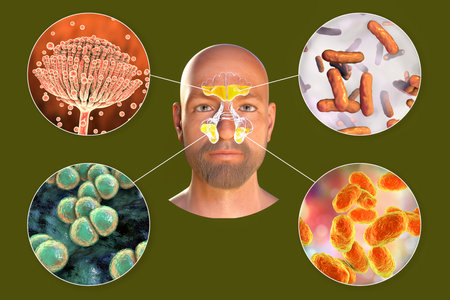 Photo of Rhinosinusitis and - ID:1-171140164 - Royalty Free Image ...