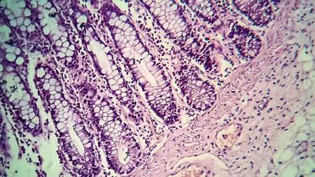 Bacillary dysentery, light micrograph, photo under microscope showing ...