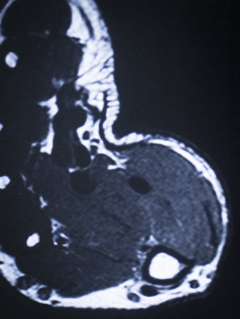 MRI magnetic resonance imaging medical scan test results of foot and ...