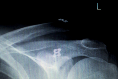 Shoulder back ribs orthopedics Xray test scan result used by ...