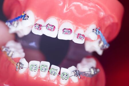 Modern metal retainers and plastic algners wire dental brackets teeth ...