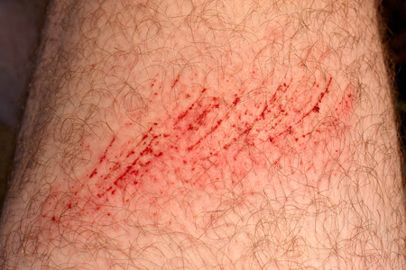 Scratches the skin Images - Search Images on Everypixel