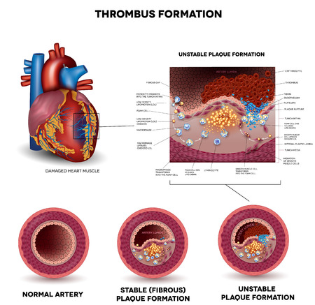Vector of Blood clot formation. Coronary - ID:1-38473543 - Royalty Free ...
