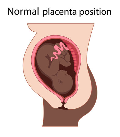 Fetus in Uterus During Pregnancy. Normal Placental Locations Woman with ...