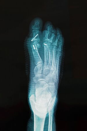 Photo of X-ray of foot after surgery to - ID:1-135048874 - Royalty Free ...