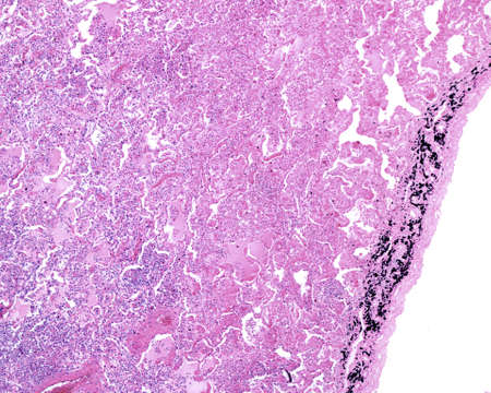 Photo of Periphery of a human lung - ID:1-188239859 - Royalty Free ...
