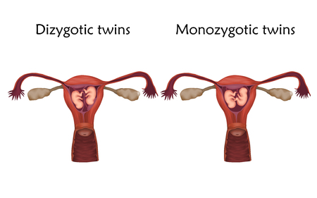 Vector of Multiple pregnancy. Dizygotic - ID:1-96631142 - Royalty Free ...