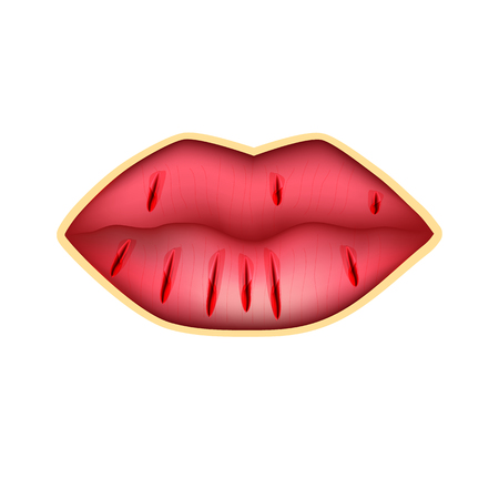 Cracks in the lips. Dry chapped lips. Infographics. Vector illustration ...