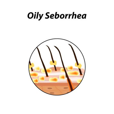 Photo of Oily seborrhea of skin and - ID:124785358 - Royalty Free Image ...