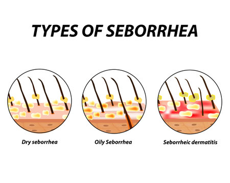 Vector of Types of seborrhea. Seborrhea - ID:1-124785360 - Royalty Free ...