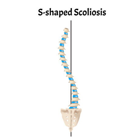 Vector of S-shaped scoliosis. - ID:1-137161668 - Royalty Free Image ...