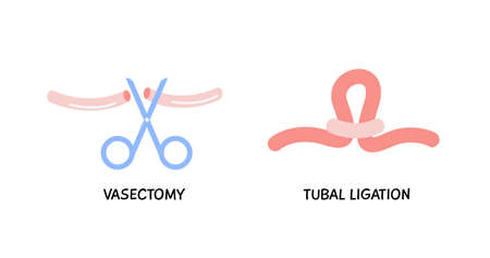 Vector of Vasectomy. Male or female - ID:1-173045722 - Royalty Free ...